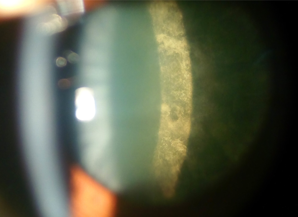 CATARACT IS THE MOST COMMON CAUSE OF BLINDNESS - SAMWUMED